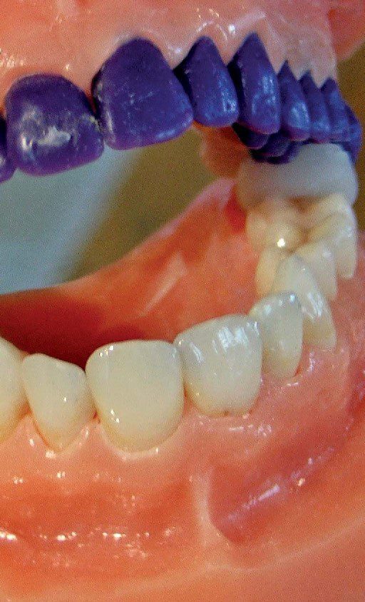 Information for dental prostheses by glass ceramics - Glasmuseum ...